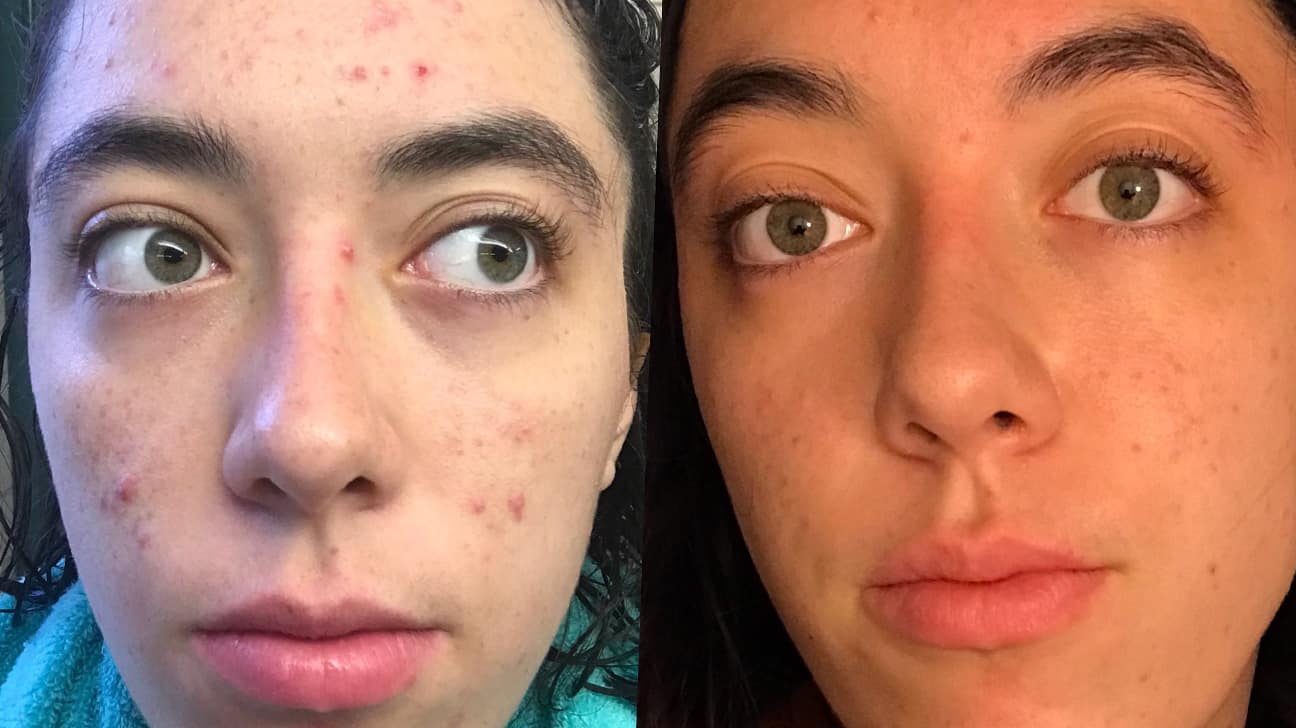 Tretinoin Skin Care Creams Focus Aesthetics